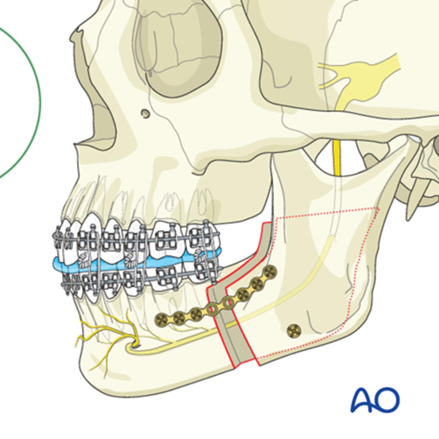 “What are Important Landmarks in the Bilateral Sagittal Split Osteotomy ...