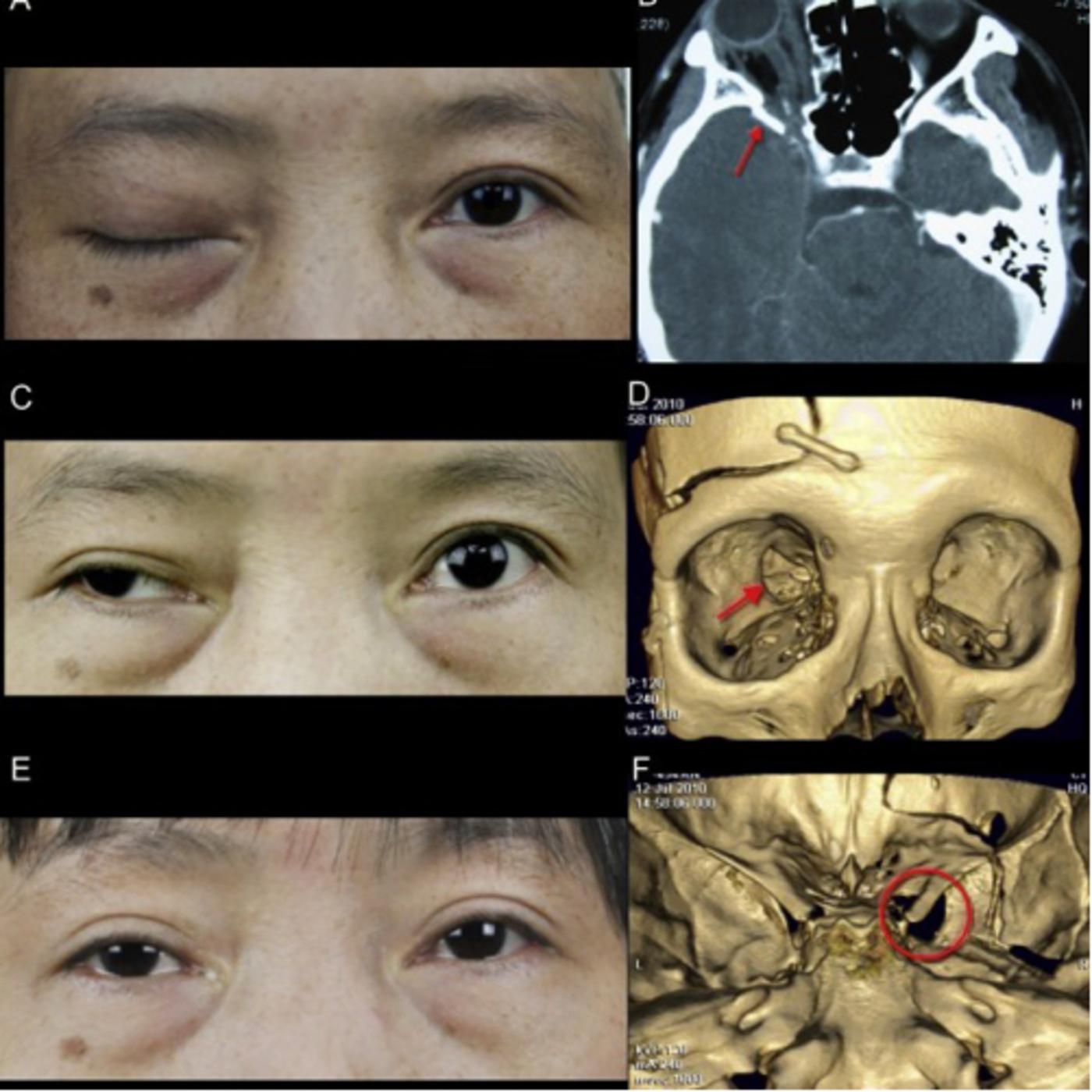 “What Are Key Differences Between Superior Orbital Fissure Syndrome and ...