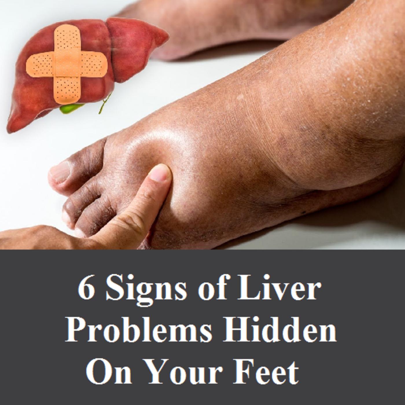 6 Signs of Liver Problems Hidden On Your Feet - sumaiyya siddiqui ...